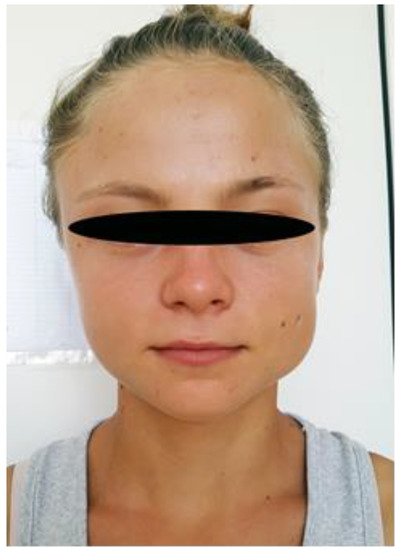 Unusual Case of Masseter Muscle Hypertrophy in Adolescence—Case Report ...