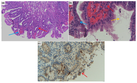 Evolution of Diagnostic Methods for Helicobacter pylori Infections ...