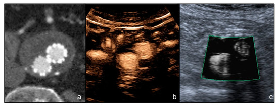 Diagnostics | Free Full-Text | EVAR Follow-Up with Ultrasound Superb ...