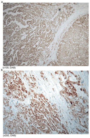 p53 Immunohistochemistry and Mutation Types Mismatching in High-Grade ...