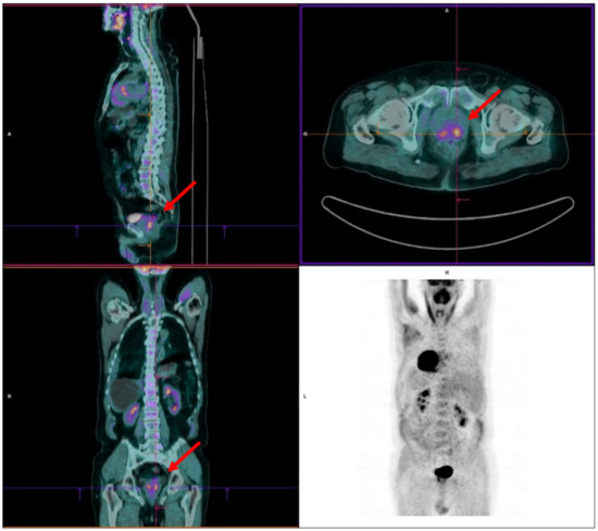Beyond the Prognostic Value of 2-[18F]FDG PET/CT in Prostate Cancer: A ...