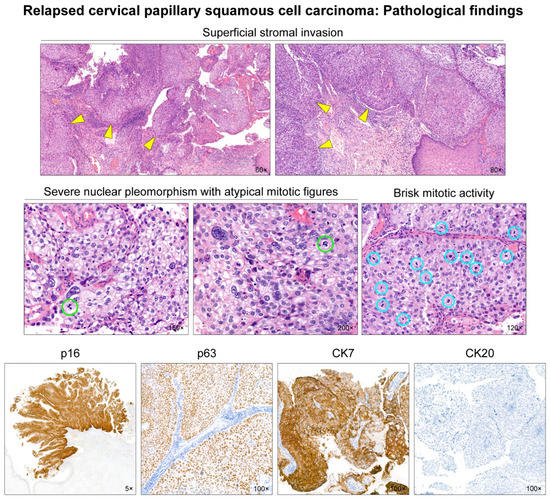 Local and Metastatic Relapses in a Young Woman with Papillary Squamous ...