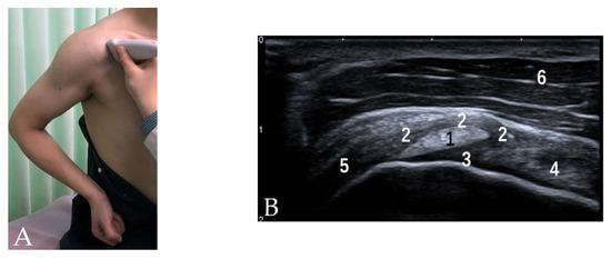 Anchoring Apparatus of Long Head of the Biceps Tendon: Ultrasonographic ...