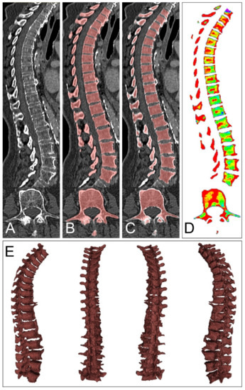 Dual-Energy CT, Virtual Non-Calcium Bone Marrow Imaging of the Spine ...