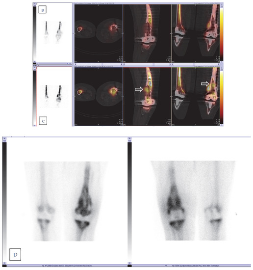 The Role of Nuclear Medicine Imaging with 18F-FDG PET/CT, Combined ...