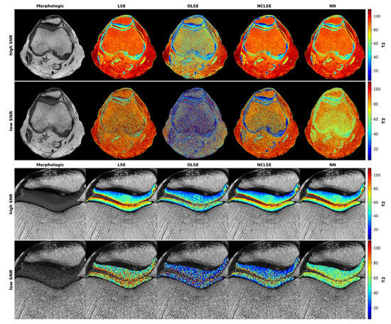 Fast, Accurate, and Robust T2 Mapping of Articular Cartilage by Neural ...