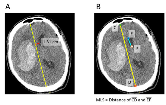 A Robust, Fully Automatic Detection Method and Calculation Technique of Midline Shift in ...
