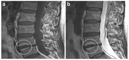Imaging Evaluation of Intervertebral Disc Degeneration and Painful ...