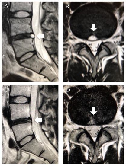 Imaging Evaluation of Intervertebral Disc Degeneration and Painful ...