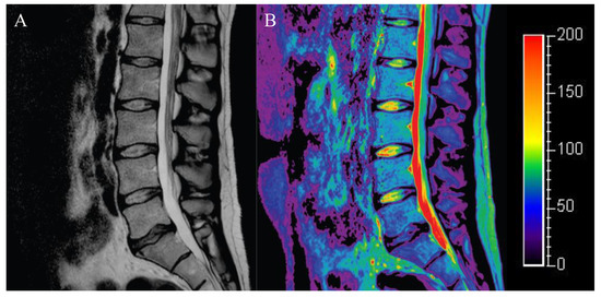 Imaging Evaluation of Intervertebral Disc Degeneration and Painful ...