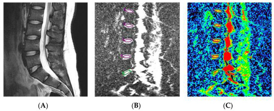 Imaging Evaluation of Intervertebral Disc Degeneration and Painful ...