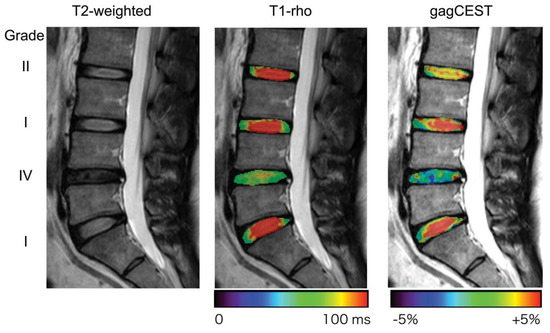 Diagnostics | Free Full-Text | Imaging Evaluation of Intervertebral ...