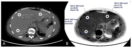 Assessment of Liver Fat: Dual-Energy CT versus Conventional CT with and ...