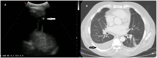 Effectiveness and Safety of Real-Time Transthoracic Ultrasound-Guided ...