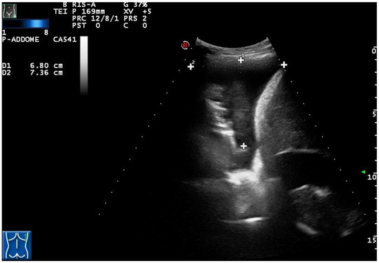 Effectiveness and Safety of Real-Time Transthoracic Ultrasound-Guided ...