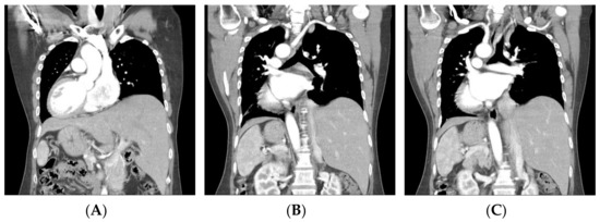 Left Nonrecurrent Laryngeal Nerve with Situs Inversus Totalis
