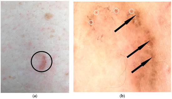 Assessment of Basal Cell Carcinoma Using Dermoscopy and High Frequency ...