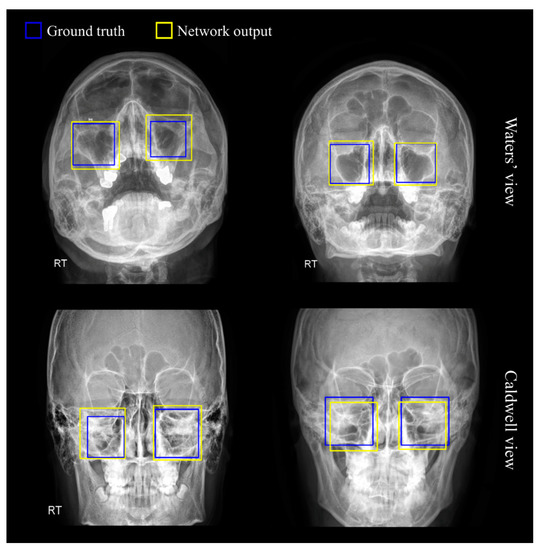 Aux-MVNet: Auxiliary Classifier-Based Multi-View Convolutional Neural Network for Maxillary ...