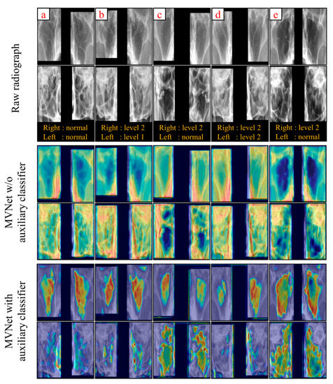 Aux-MVNet: Auxiliary Classifier-Based Multi-View Convolutional Neural Network for Maxillary ...