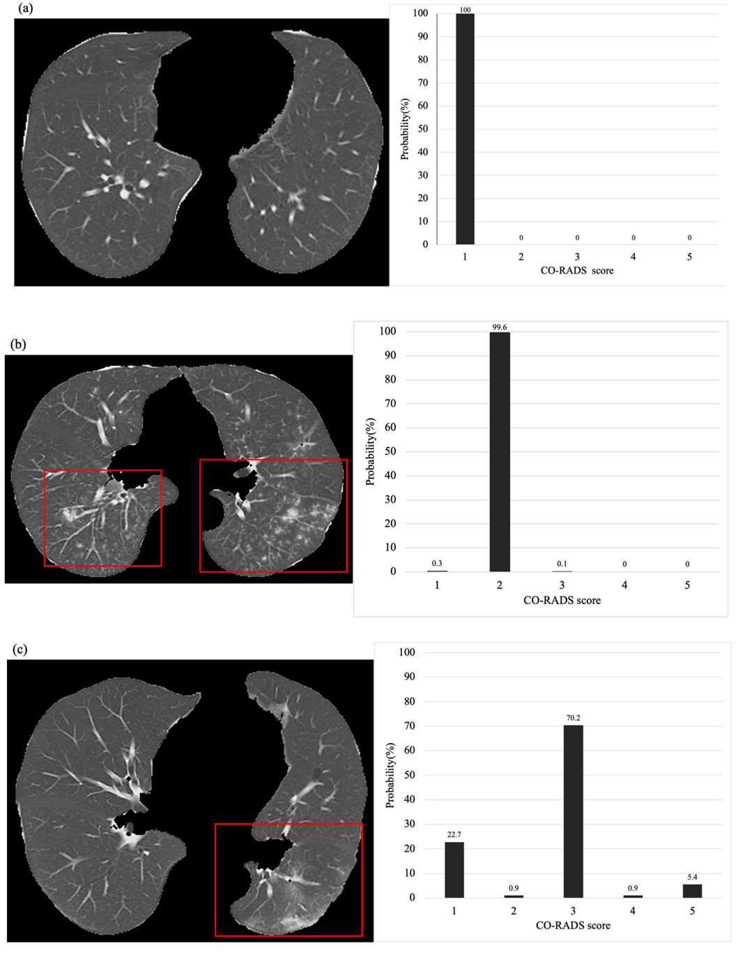 Comparison of CO-RADS Scores Based on Visual and Artificial ...