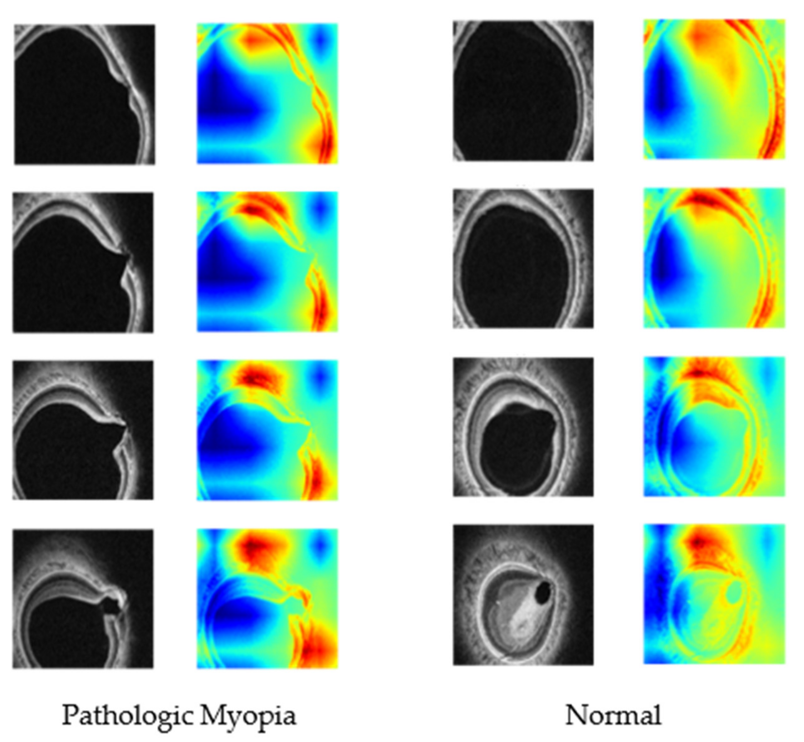 Deep Learning Model Based on 3D Optical Coherence Tomography Images for the Automated Detection ...