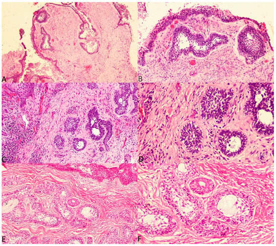 Subepithelial Hyalinisation Predicts Recurrence of Unicystic Ameloblastomas
