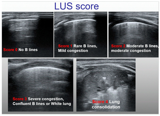 Overview of Lung Ultrasound in Pediatric Cardiology