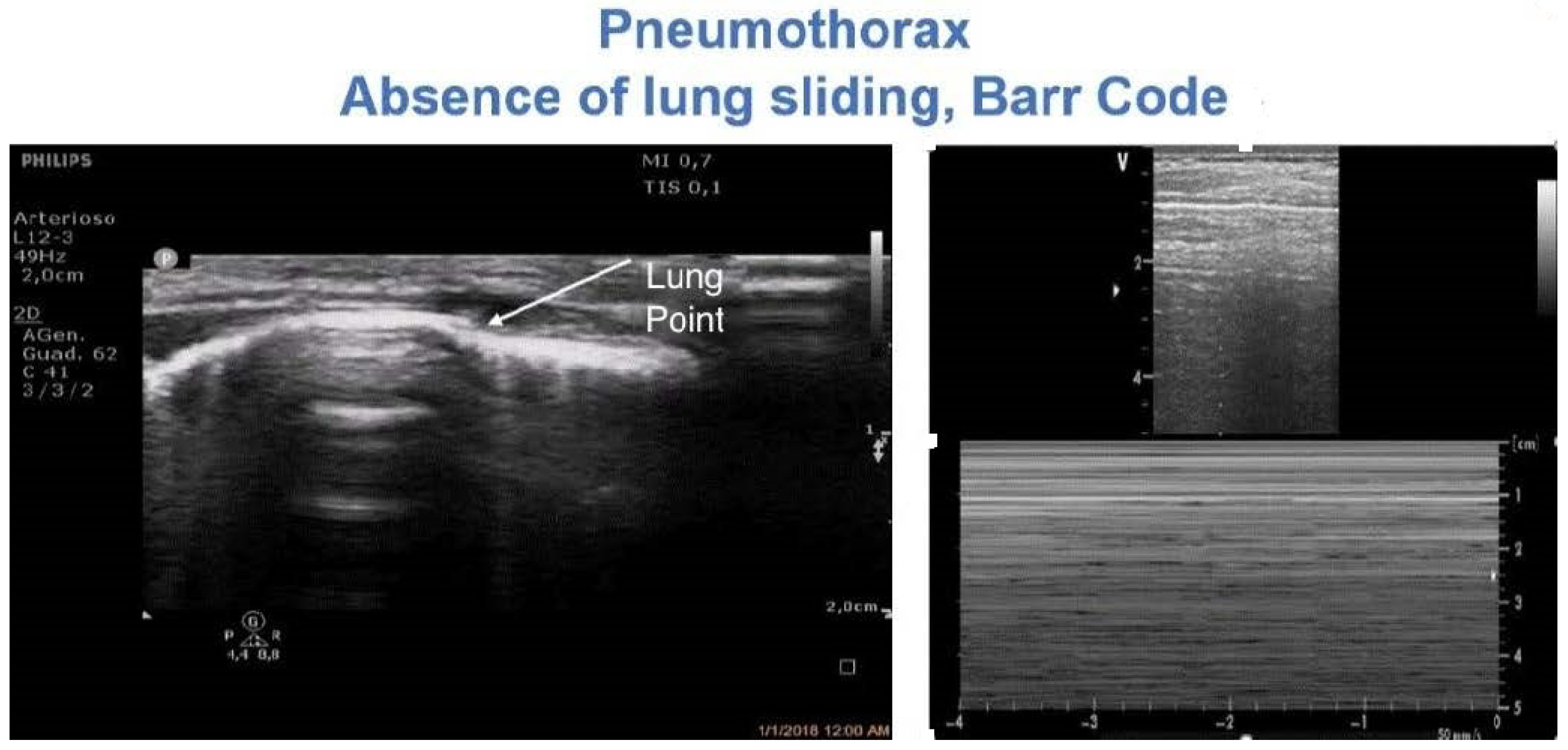 Overview of Lung Ultrasound in Pediatric Cardiology