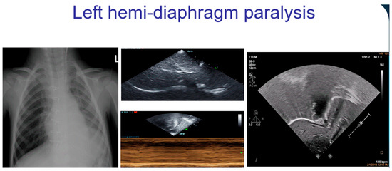 Overview of Lung Ultrasound in Pediatric Cardiology