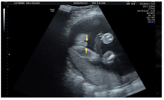 Ultrasonographic Diagnosis of Fetal Hypospadias