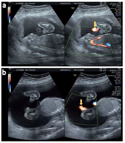 Ultrasonographic Diagnosis of Fetal Hypospadias