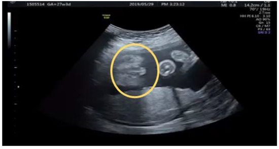 Ultrasonographic Diagnosis of Fetal Hypospadias