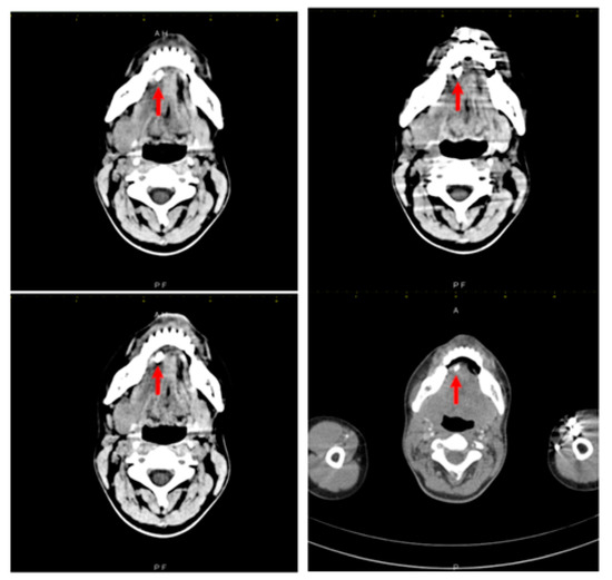 Multiple Faces of Cervical Lesions in Children