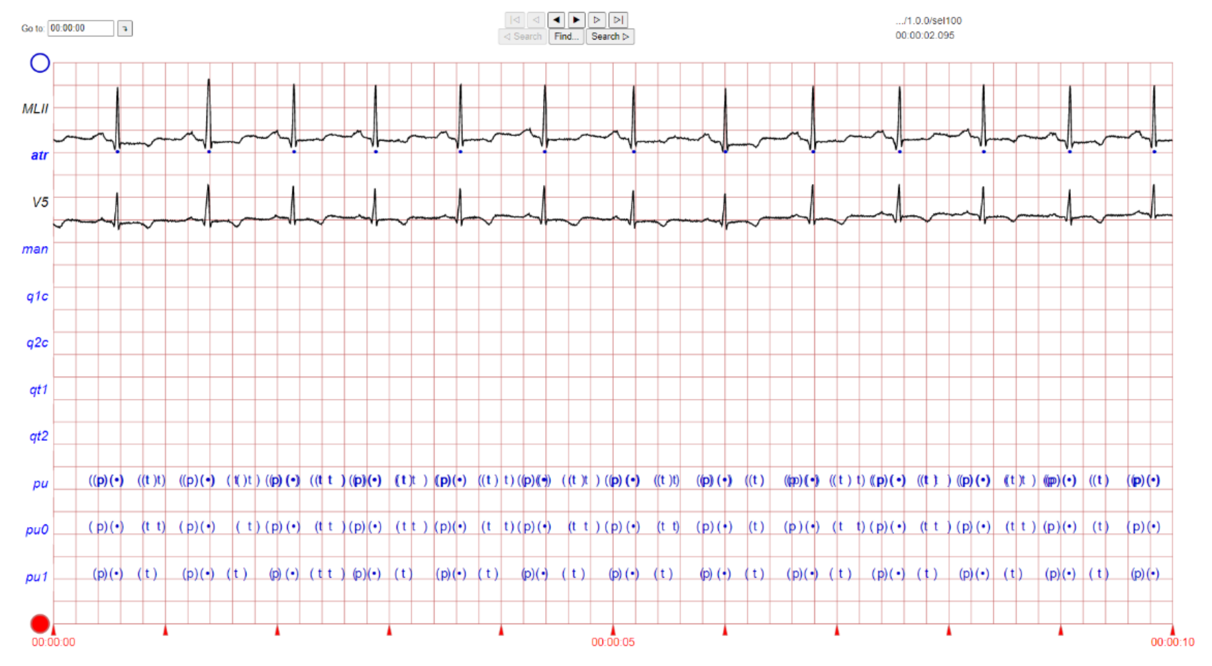 An Embedded System Using Convolutional Neural Network Model for Online and Real-Time ECG Signal ...