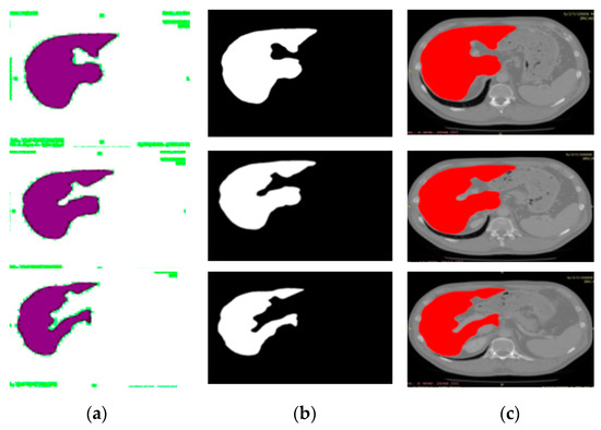 Liver Tumor Localization Based on YOLOv3 and 3D-Semantic Segmentation Using Deep Neural Networks