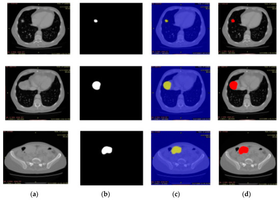 Liver Tumor Localization Based on YOLOv3 and 3D-Semantic Segmentation Using Deep Neural Networks