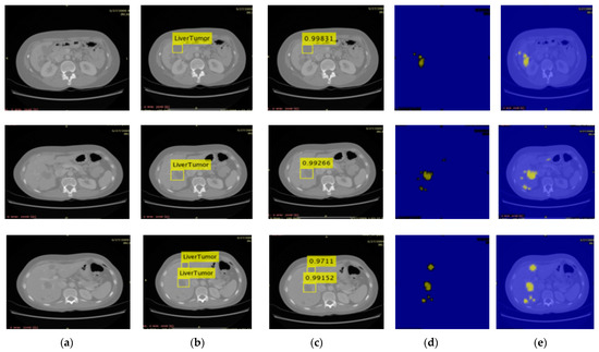 Liver Tumor Localization Based on YOLOv3 and 3D-Semantic Segmentation Using Deep Neural Networks