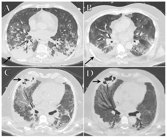 An Imaging Overview of COVID-19 ARDS in ICU Patients and Its ...