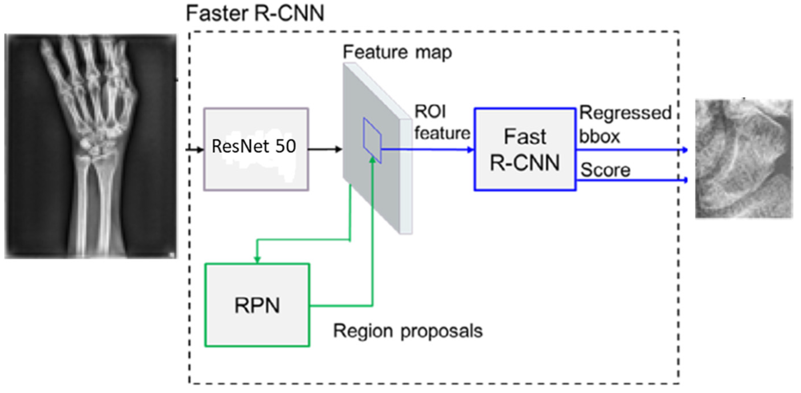 Scaphoid Fracture Detection by Using Convolutional Neural Network