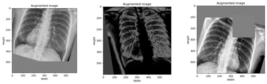 Deep Learning in Multi-Class Lung Diseases’ Classification on Chest X ...