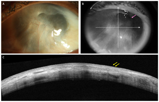Role of AS-OCT in Managing Corneal Disorders