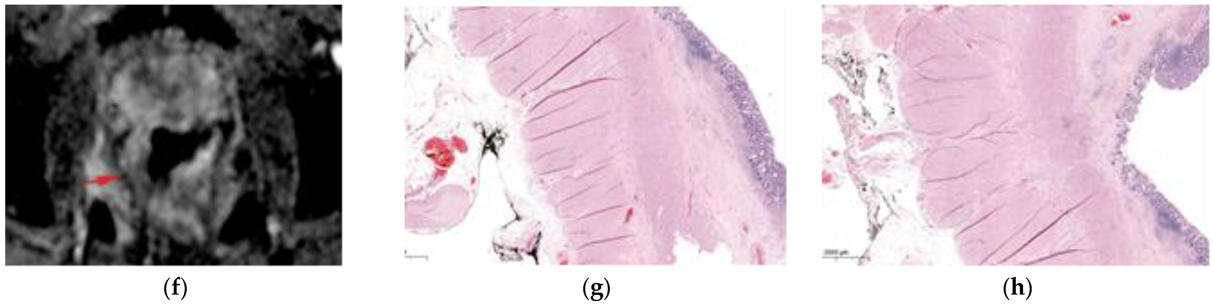 MRI Evaluation of Complete and Near-Complete Response after Neoadjuvant ...