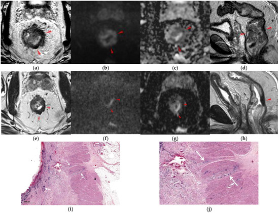 MRI Evaluation of Complete and Near-Complete Response after Neoadjuvant ...