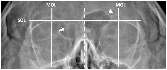 Frontal Sinus Xray