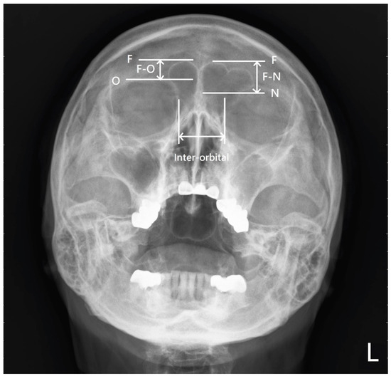 Sinus Plain Film Can Predict a Risky Distance from the Lacrimal Sac to ...
