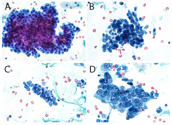 The Diagnostic Dilemma of Urothelial Tissue Fragments in Urinary Tract ...