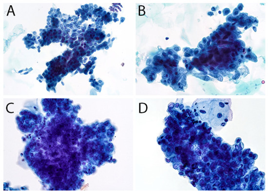 The Diagnostic Dilemma of Urothelial Tissue Fragments in Urinary Tract ...