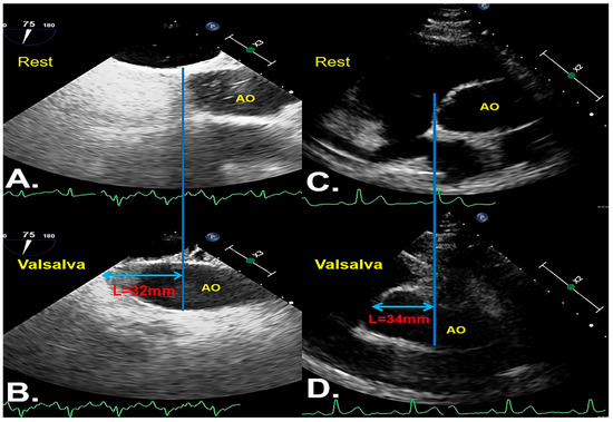 Aortic Root Downward Movement as a Novel Method for Identification of ...
