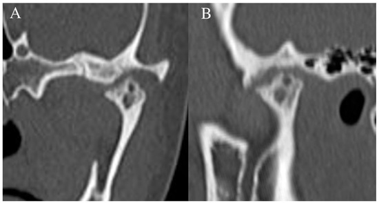 Imaging of the Temporomandibular Joint