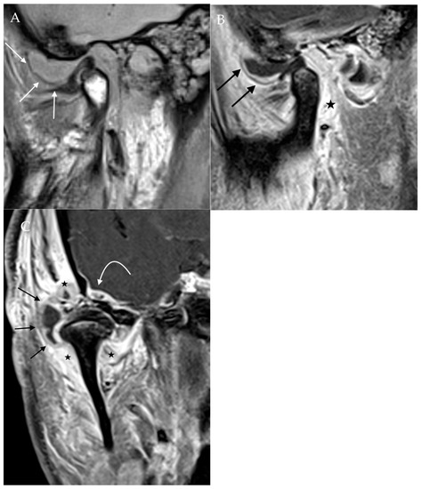 Imaging of the Temporomandibular Joint